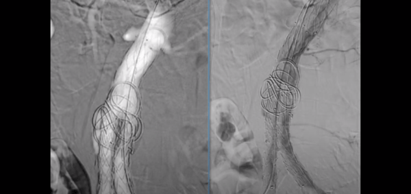 Zero Contrast EVAR – Endovascular Aneurism Repair with CO2 angiography