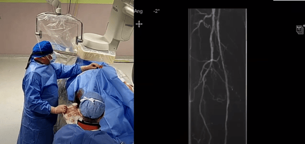 CO2 automatic angiography – Standard Technique