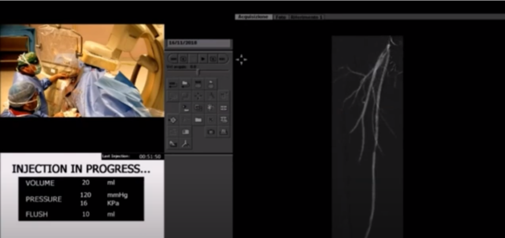 CO2 automatic angiography – Standard Technique