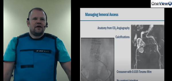 CO2 automatic angiography – Standard Technique