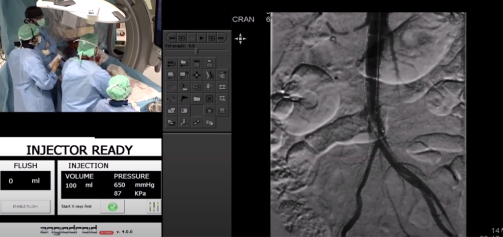 CO2 automatic angiography – Standard Technique