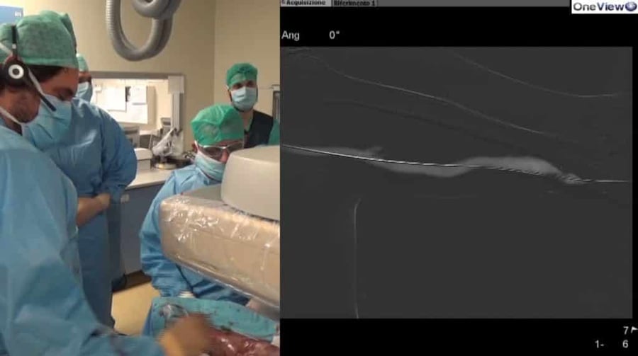 CO2 automatic angiography – Standard Technique